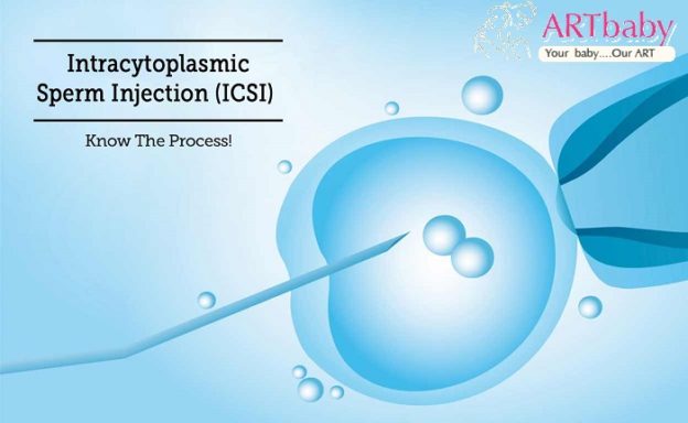 ICSI Treatment Archives - ART baby Egg Donors ART baby Egg Donors